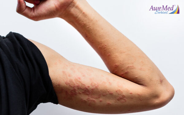 Should You Be Using Topical Steroids on Eczema? | AweMed Series